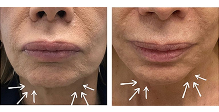 Filler FAQ: Everything You've Ever Wanted to Know about Fillers | Dr ...