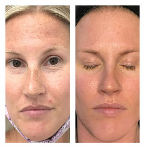 The Ultimate Guide to the Hydrafacial Experience: Add-ons, Benefits ...