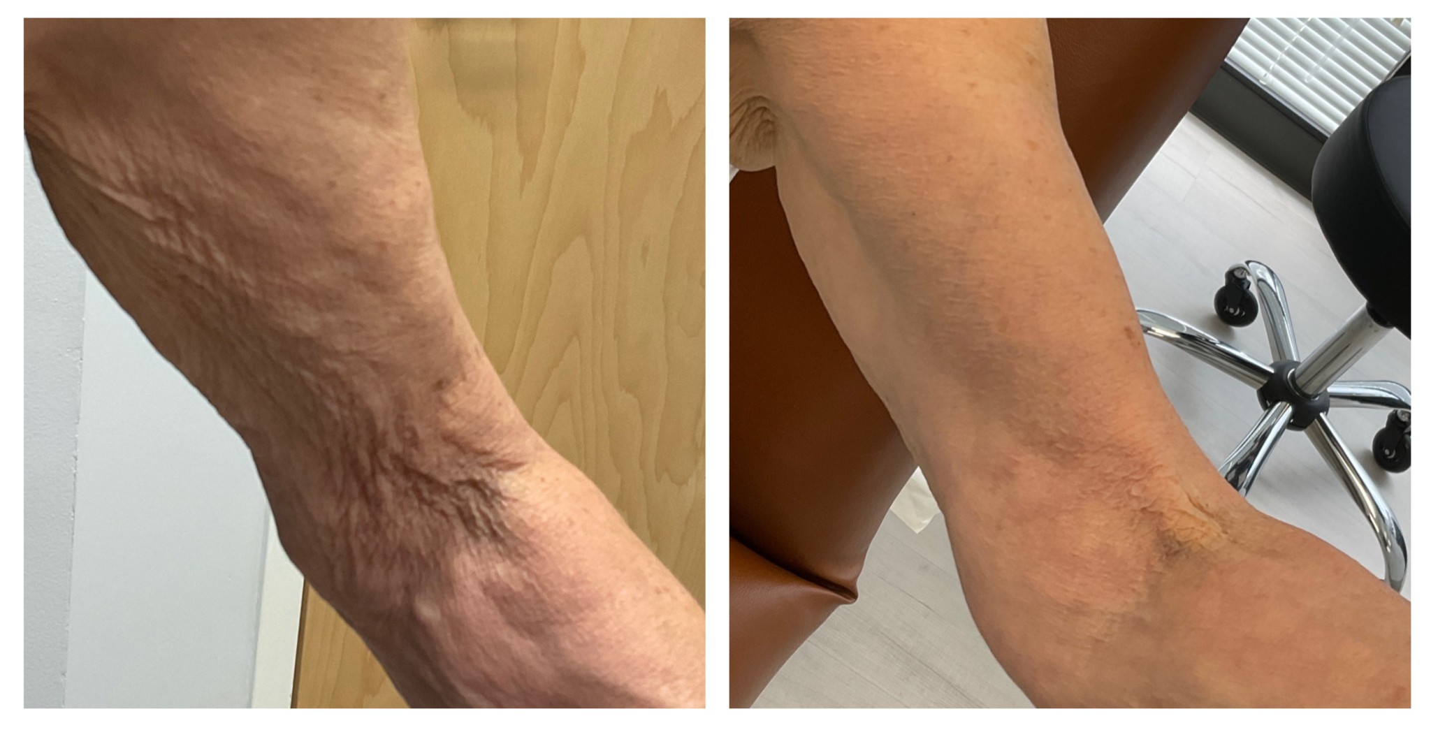 Pixel-8 vs. Morpheus8: The Ultimate Guide to Skin Tightening and Anti ...