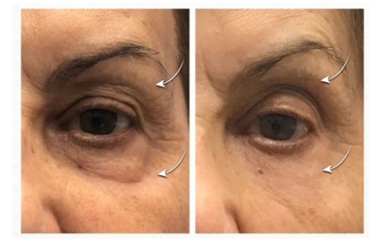 Botox vs Dysport vs Xeomin: Understanding the Differences in Cosmetic ...