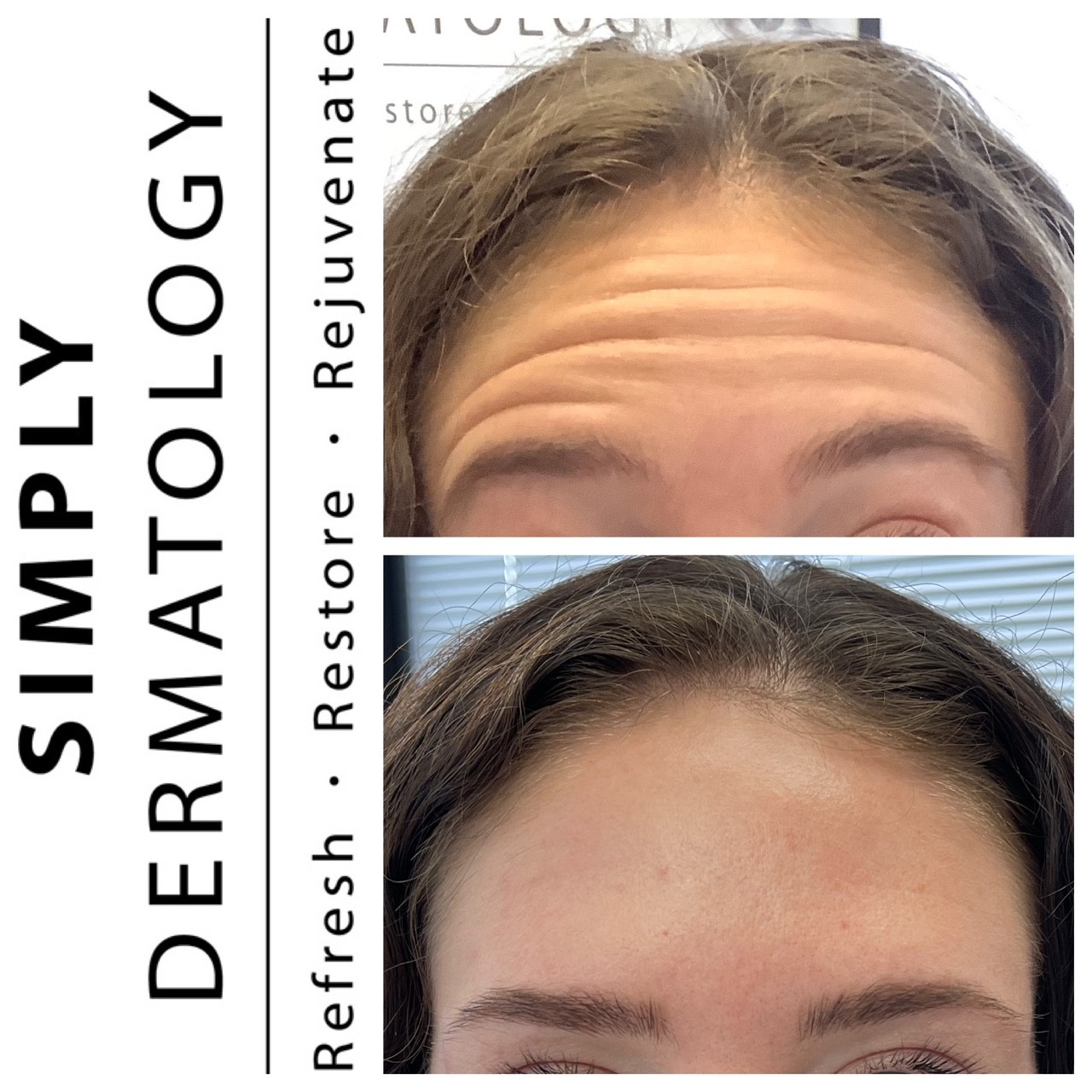 Dr. Papantoniou Explains Botox Vs. Fillers | Dr. Kally Papantoniou