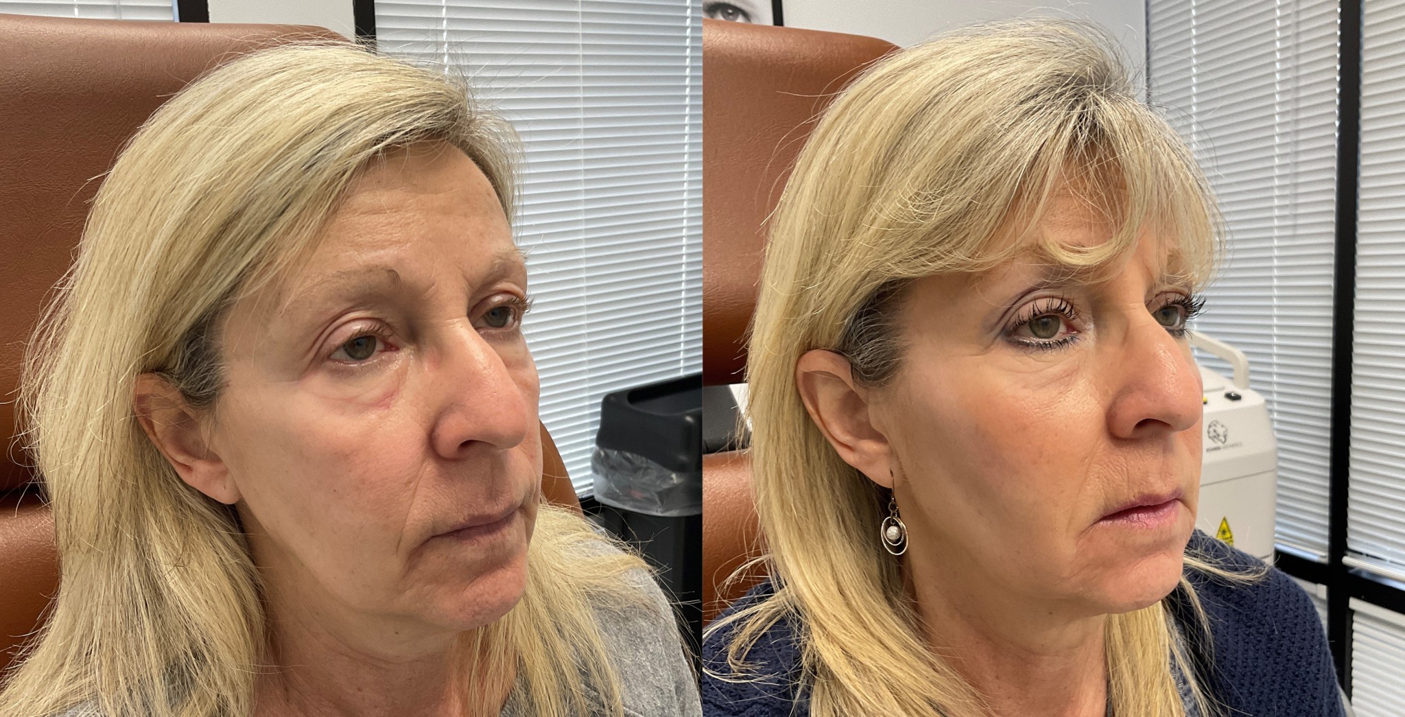Filler FAQ: Everything You've Ever Wanted to Know about Fillers | Dr ...