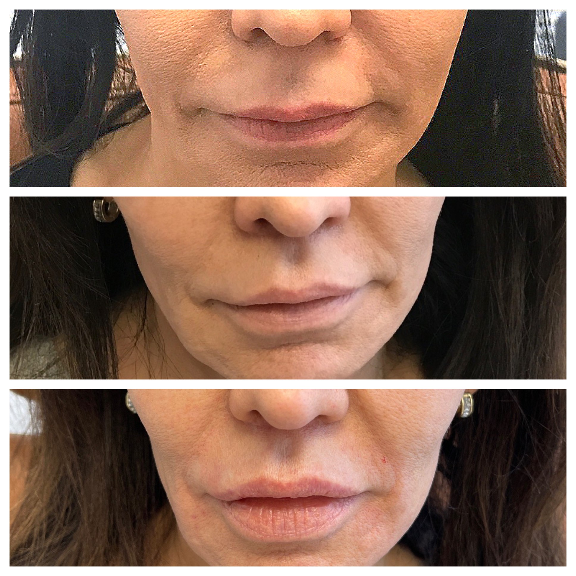 Lip Filler FAQs: Everything You've Ever Wanted to Know | Dr. Kally ...