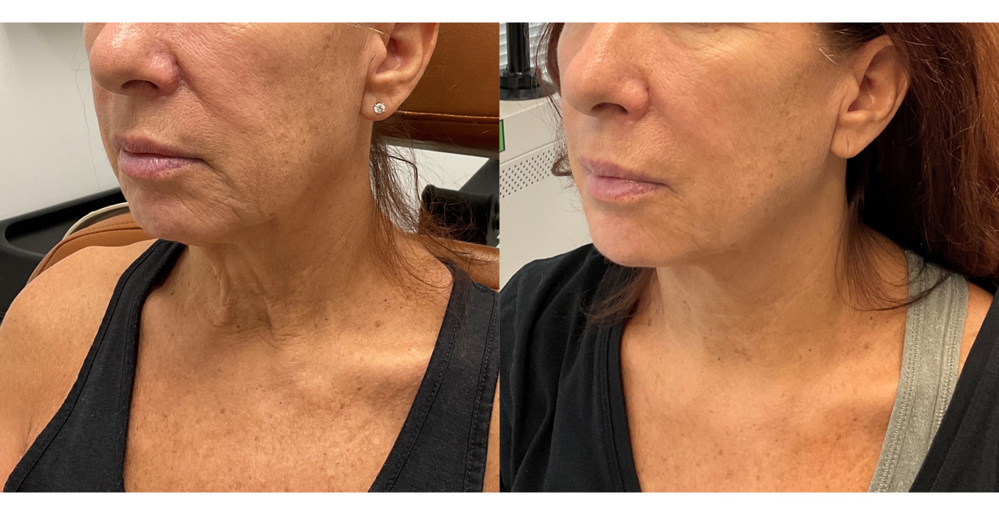 Everything you need to know about Ulthera | Dr. Kally Papantoniou